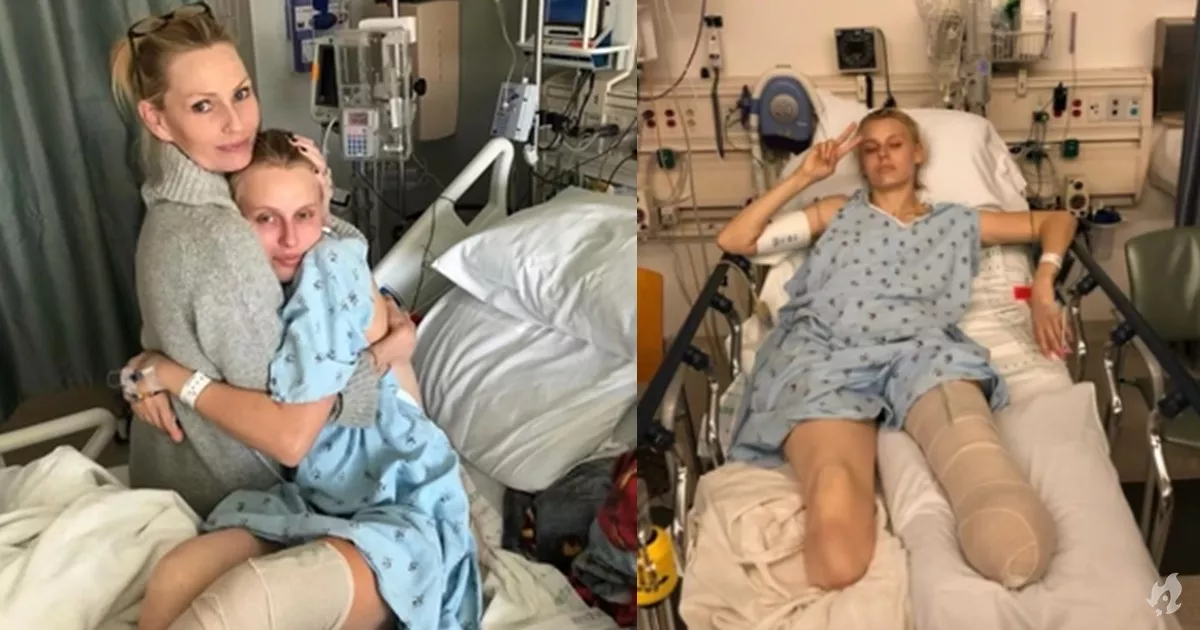 » Modelo tem as duas pernas amputadas após usar absorvente interno